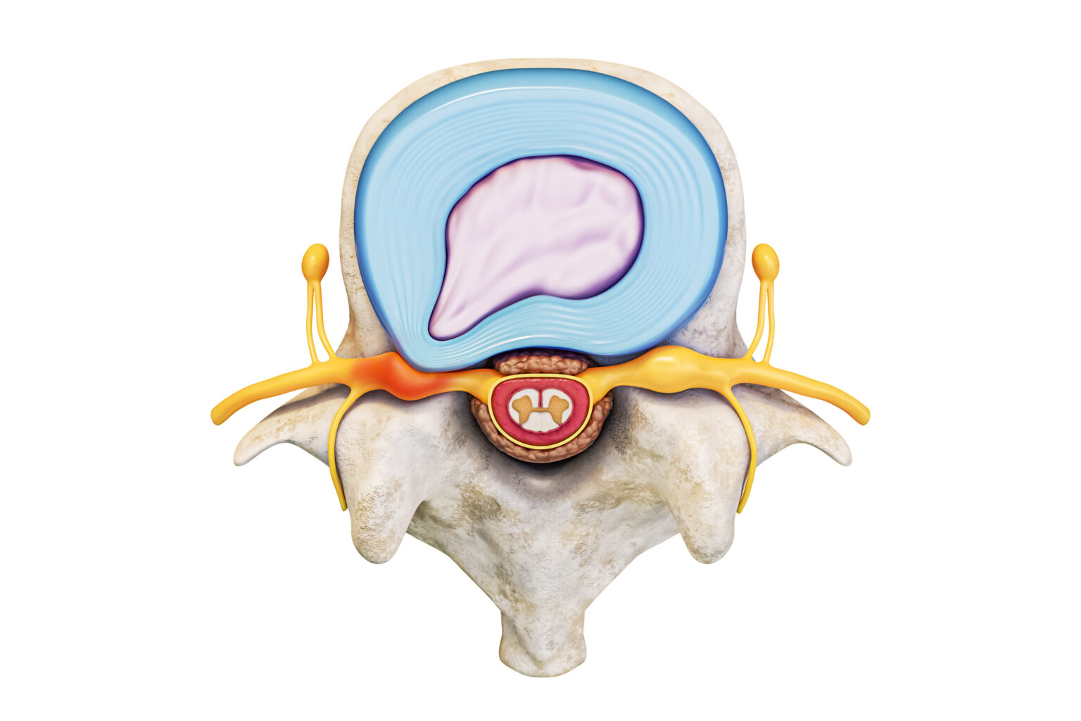 HERNIA DISCAL: TIPOS, SÍNTOMAS Y TRATAMIENTO DE FISIOTERAPIA ...