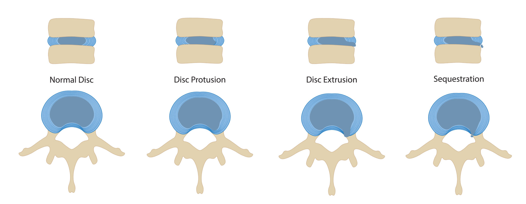 HERNIA DISCAL: TIPOS, SÍNTOMAS Y TRATAMIENTO DE FISIOTERAPIA ...